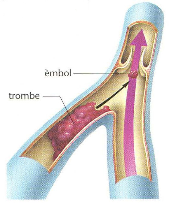 embòlia | enciclopedia.cat